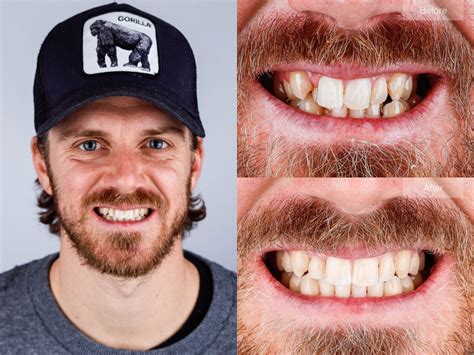 How Does Invisalign Work