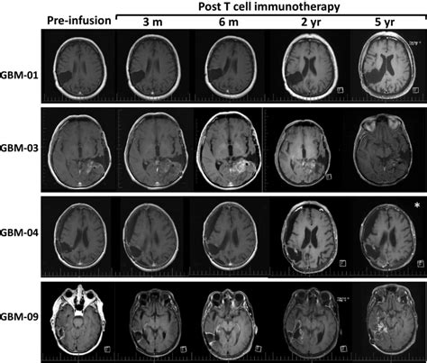 Multiplexed Immunohistochemical Analysis Of Cd3 Pd L1 And Sox 2 In Gbm