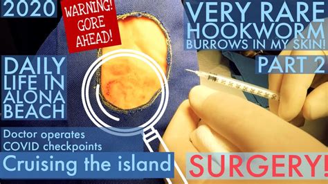 Hookworm Surgery Parasite Removal Part 2 Daily Life At Alona Beach Youtube