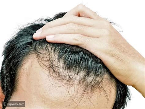 تساقط الشعر المفرط هل يشير إلى مشكلات صحية خفية؟