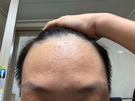 여드름 문제 지식in