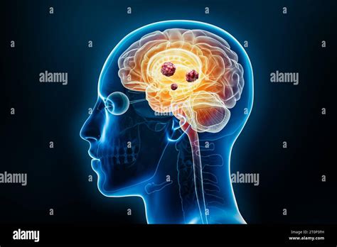 Cancer Cerveau Avec Des Cellules Cancéreuses Ou Des Tumeurs X Ray 3d