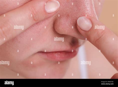 Woman Popping Pimple On Her Nose Closeup Stock Photo Alamy