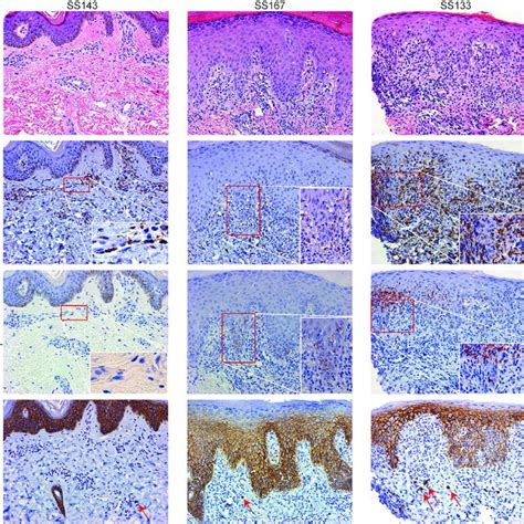 Proposed Model Of Immune Interplay In Secondary Syphilis Ss