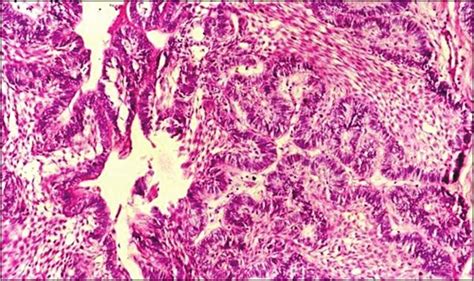 Photomicrograph Showing Plexiform Ameloblastoma With Areas Of Stellate Download Scientific