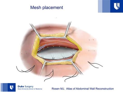 Abdominal Wall Anatomy With Respect To Understanding Component Separationpdf