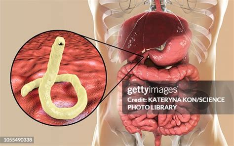 Hookworm Illustration High Res Vector Graphic Getty Images