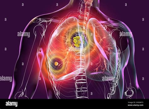 Illustration Of Primary Lung Tuberculosis Featuring The Ghon Complex
