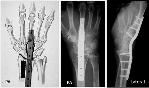 Complete Wrist Fusion Thomas R Hunt Iii Md Dsc