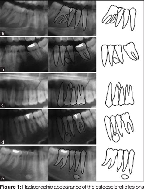 Figure 1 From Frequency And Pattern Of Idiopathic Osteosclerosis And