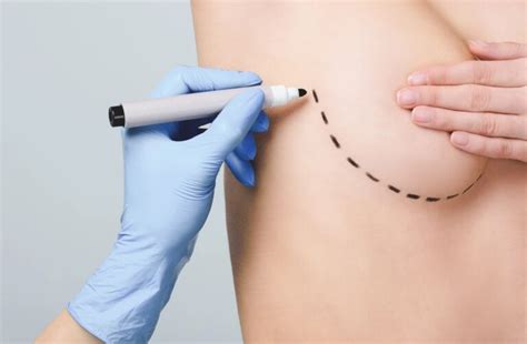 Direct To Implant Breast Reconstruction A Comprehensive Guide