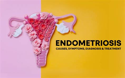 Endometriosis Causes Symptoms Diagnosis And Treatment