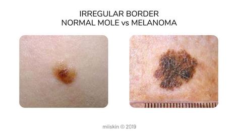 Cancerous Mole Vs Normal Mole