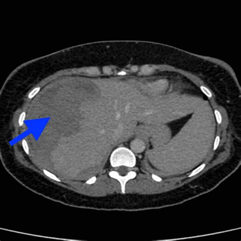 Atypical Presentation Of Subcapsular Liver Hematoma With A Delayed