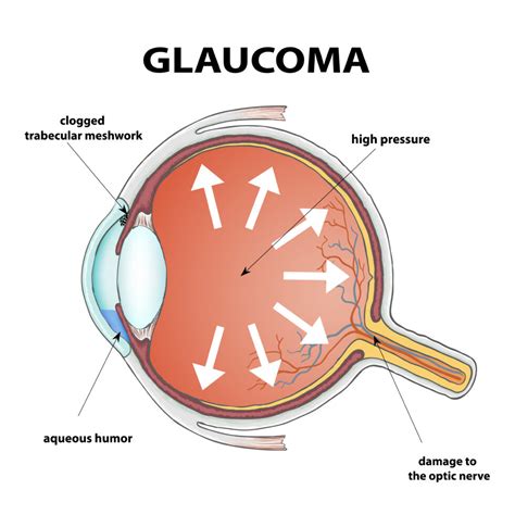 Glaucoma Dr Vijay Shetty Eye Specialist