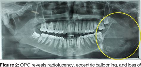 Figure 1 From A Large Aneurysmal Bone Cyst Of Mandible A Rare Case