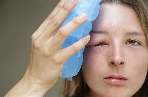 Swollen Eyelid Due To Makeup Allergy Saubhaya Makeup