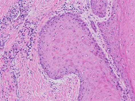 Second Biopsy Of The Mass Showing Well Differentiated Scc Hematoxylin