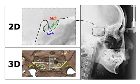 Figure 1 From The Left And Right Differences In Sella Turcica Bridging Between Sex Analyzed By