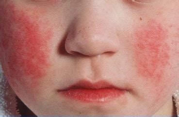 ERITEMA INFECCIOSO Quizlet