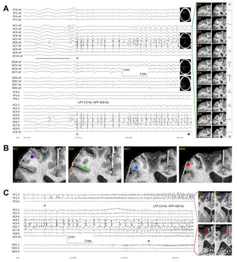 Stereotactic Eeg Seeg Recording In A Patient With Frontal Lobe