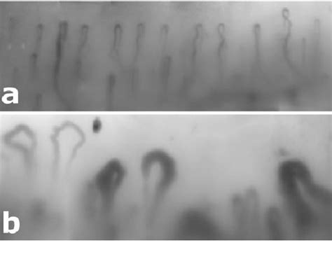 Figure 2 From Evidence Based Management Of Raynauds Phenomenon