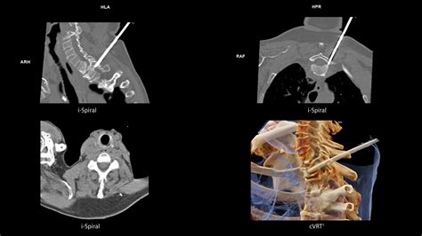 Ct Guided Interventional Procedures Siemens Healthineers