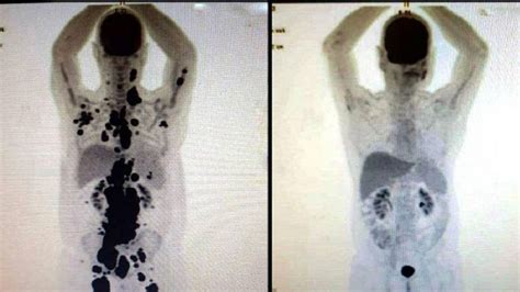 Imágenes impactantes del antes y después de un paciente con cáncer