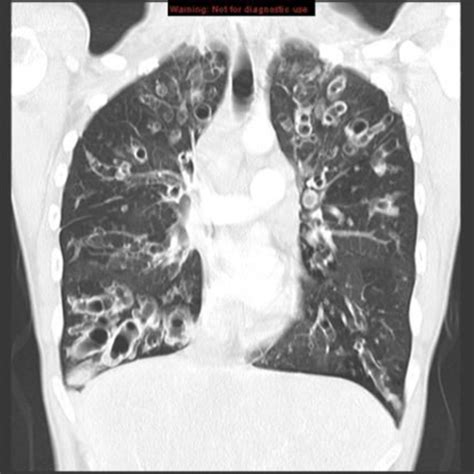 Bronchiectasis And Cf Flashcards Quizlet