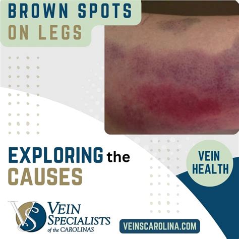 Understanding Brown Spots On Legs Causes And Treatments Vein