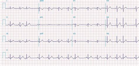 Atlas Of Electrocardiography Basicmedical Key
