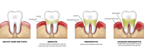 Advanced Periodontal Disease Treatment Costs Pregnant Health Tips