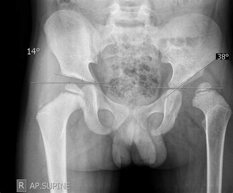 Acetabular Index Pacs