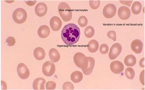 Microcytic And Macrocytic Anaemia Flashcards Quizlet