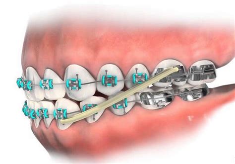 Mordida Cruzada que es y su tratamiento Clínica Dental Jose Luis