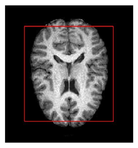 Segmentation For Brain Mri A Original Image And Initial Level Set