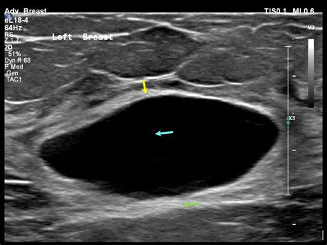 Atlas Of Breast Cancer Early Detection