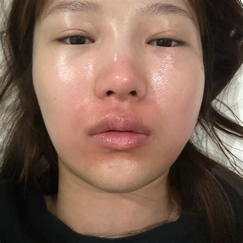 이상한 과자가게 이사장 알러지가 없다고 방심하면 안되는 이유 다들 해외가실 때 알러지 조심하시고 약 꼭 챙겨가세요