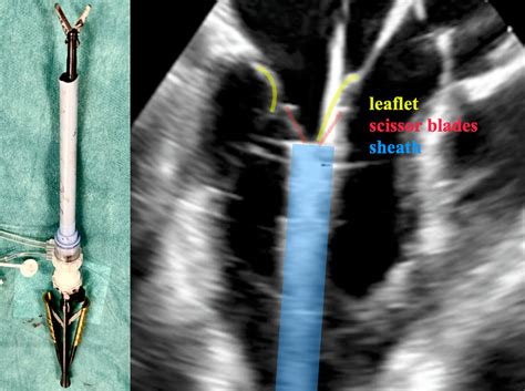Novel Technique To Prevent Outflow Tract Obstruction In Transapical