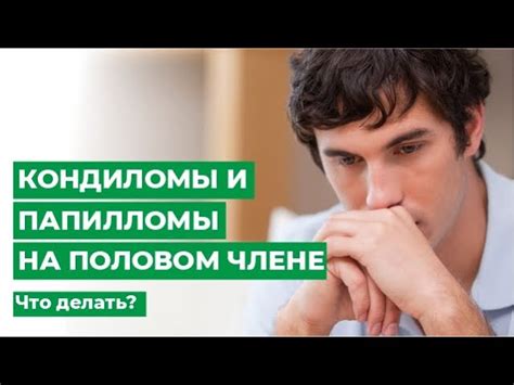 Лечение кондилом у мужчин как лечить бородавки в паху у мужчин