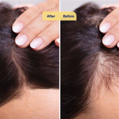 Reginera Hair Treatment Hair Fall Treatments Kuwait