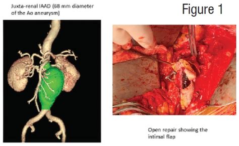 Isolated Infrarenal Aortic Dissection Hybrid Treatment Medical Market