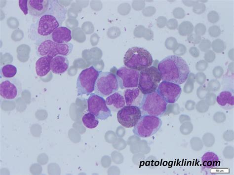 Klasifikasi Leukemia Mieloblastik Akut Aml Menurut Fab