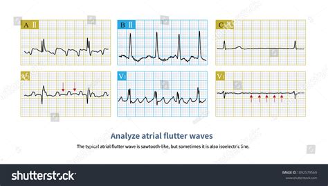 During Atrial Flutter Atrial Flutter Waves Stock Illustration