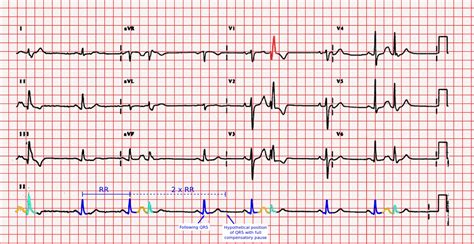 Premature Ventricular Contractions Vs Premature Atrial Contractions