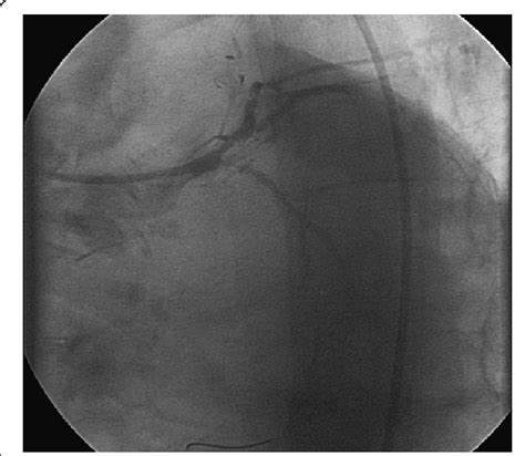 Preoperative Angiography Stenosis Of The Proximal Ramus Circumflexus