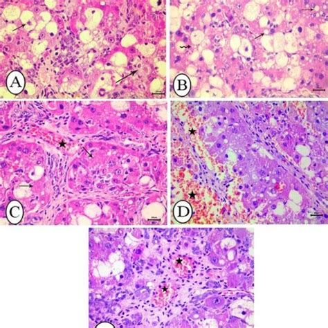 Histological Metavir Fibrosis Grading System Download Scientific Diagram