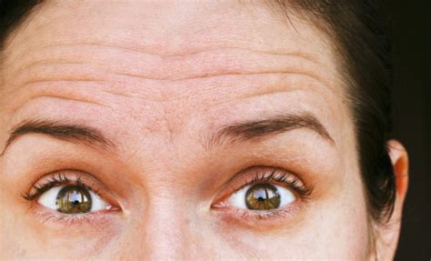 How To Get Rid Of Forehead Lines Naturally Simple Tips For Women