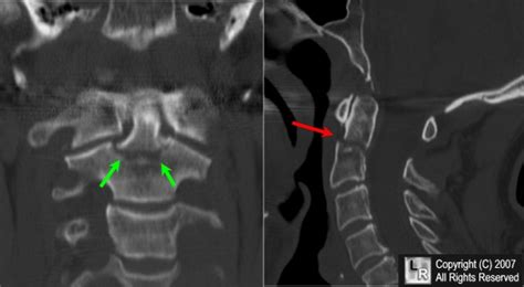 Learning Radiology Fracture Of Dens Odontoid