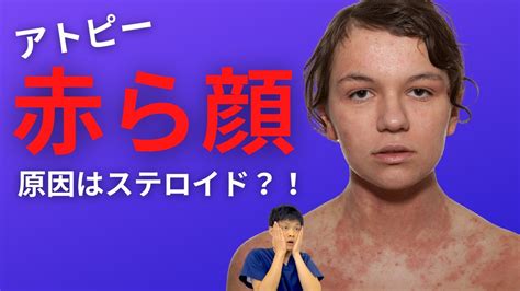【アトピー赤ら顔】あなたの赤ら顔が治らない理由”ステロイド”？！ Youtube